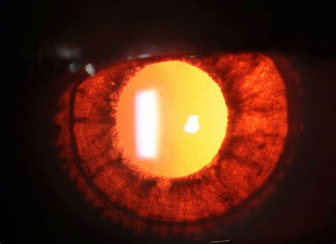 Retinal Vasoproliferative Tumor In Ocular Albinism Pmc