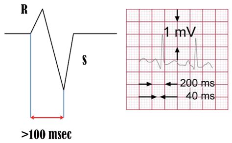 Svt With Aberrancy Versus Vt Rebel Em Emergency Medicine Blog