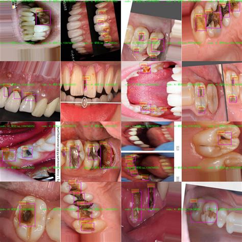 牙齿龋齿检测数据集总结牙齿数据集 Csdn博客