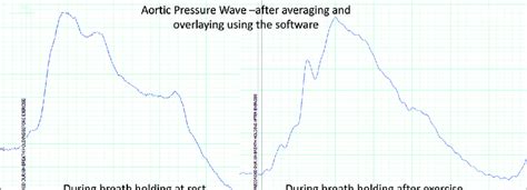 A And B Aortic Pressure Wave Forms Derived From The Surface Of Chest B A Download