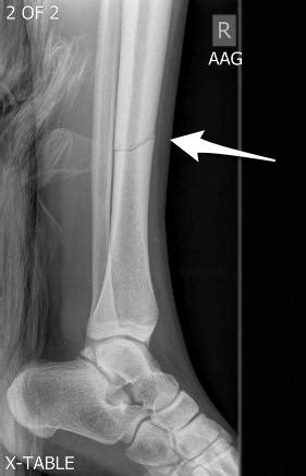 Tibia Fracture Dr Geier