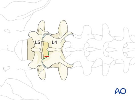 Interlaminar Endoscopic Lumbar Discectomy Ield For Lumbar Disc