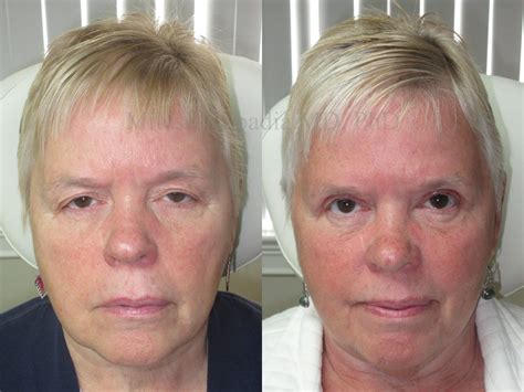 Ptosis Repair And Eyelid Retraction Boston Eyelid Surgery