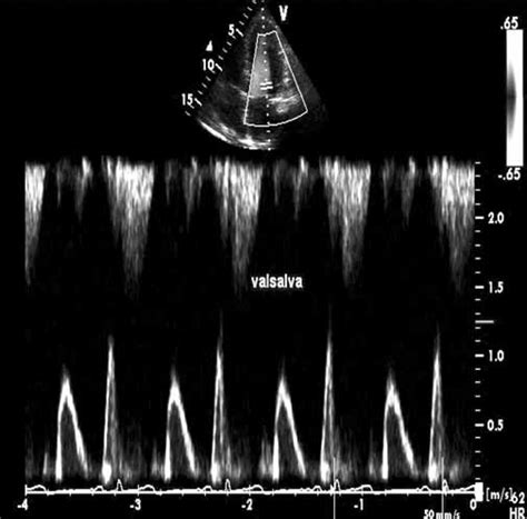 A Shows Stage Ii Diastolic Dysfunction With Pseudonormalised Pattern