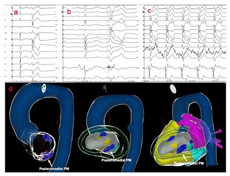 Electroanatomical Mapping And Ablation Of Premature Ventricular Download Scientific Diagram