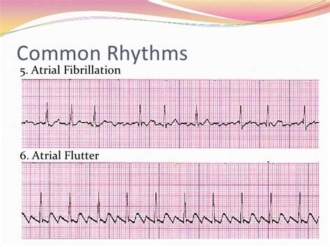 12 Lead Ekg Interpretation Ekg Interpretation Paramedic School Nursing Notes