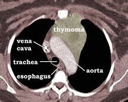 Thymoma Prolife Cancer Centre
