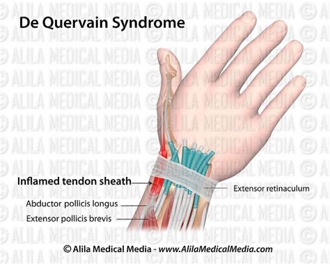 Alila Medical Media De Quervains Injection Medical Illustration
