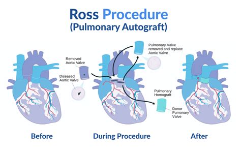 Guide To Aortic Valve Repair And The Ross Procedure Columbia Surgery
