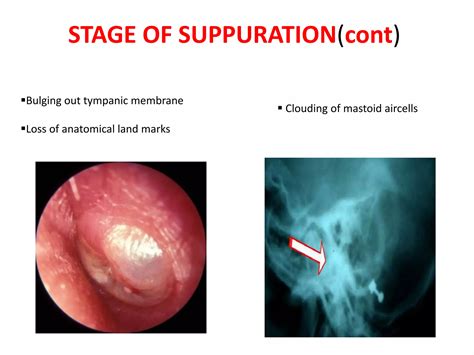 Acute Suppurative Otitis Media Pptx