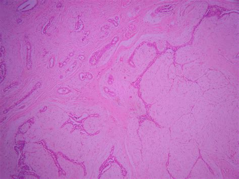 Fibroadenoma Histopathologyguru