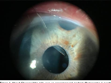 Figure 1 From Ciliary Sulcus Implantation Of Ahmed Glaucoma Valve In Patients With Corneal