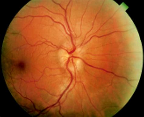 Optic Neuritis With Marked Distension Of The Optic Nerve Sheath Due To