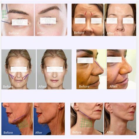 Buy Wholesale China Minerva Ce Approved Hilos Skin Tensioning Double