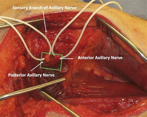 View Of The Axillary Nerve Emerging From The Quadrangular Space The Download Scientific
