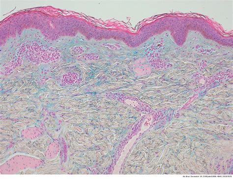 Acral Persistent Papular Mucinosis With Pruritic Skin Lesions Anais Brasileiros De Dermatologia