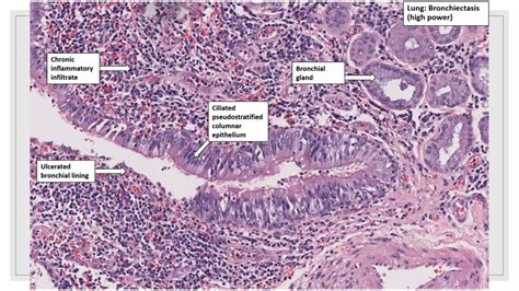 Bronchiectasis Pathology For Nurses Pptx