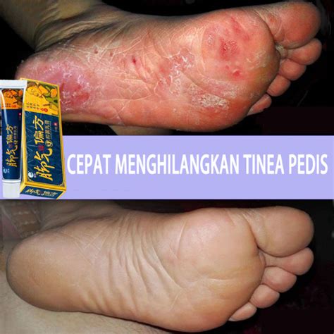Krim Kaki Gatal Krim Anti Jamur Yang Menghilangkan Gatal Dan Psoriasis Pada Kaki Salep Kurap