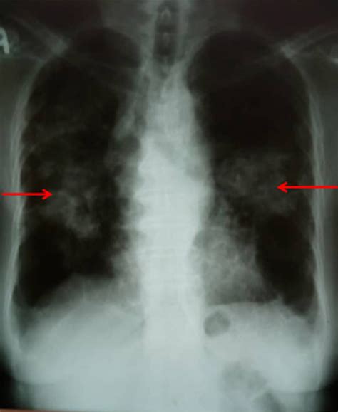 Chest X Ray P A View Shows Reticulonodular Shadows And Multiple Download Scientific Diagram