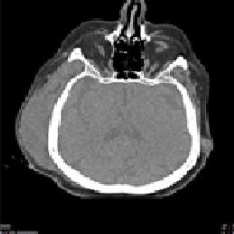 Temporal Abscess In The Right Zone Download Scientific Diagram