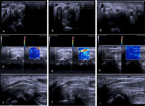 Multimodal Ultrasound Imaging For Pre And Postoperative Evaluation Of