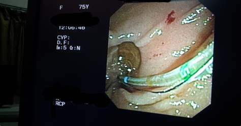 Ercp And Egd Intra Diverticular Papilla