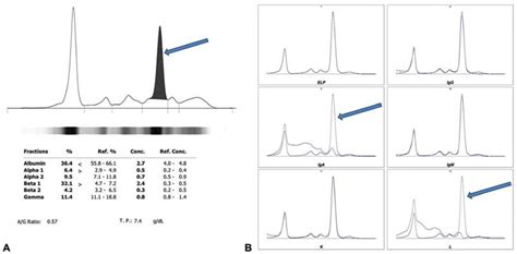 M spike in the β 1 region on CZE and M spike comprising of Download Scientific Diagram