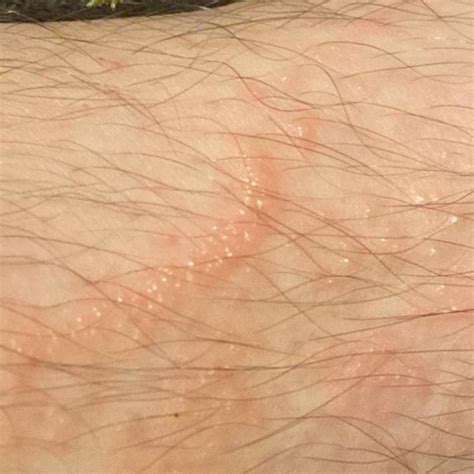 Linear Lichen Online Consultation Ai Dermatologist