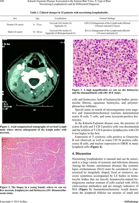 Kikuchi Fujimoto Disease Associated To The Epstein Barr Virus A Type Of Rare Necrotizing