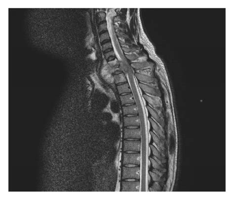 A Case Illustration 4 Preoperative Mri Showing A Paraspinal Abscess