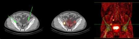 On The Left CT Image Of The Same Area Revealed No Pathologic Enlarged Download Scientific
