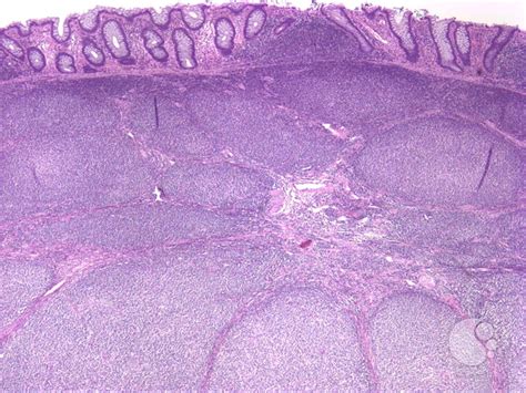 Follicular Lymphoma Grade 1 3 In A Hepatic Flexure Polyp 2