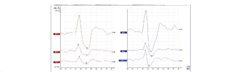 CVEMP Testing Showing Low Thresholds For Both Ears Download Scientific Diagram