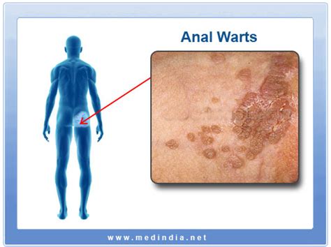 Infographic On Anal Warts