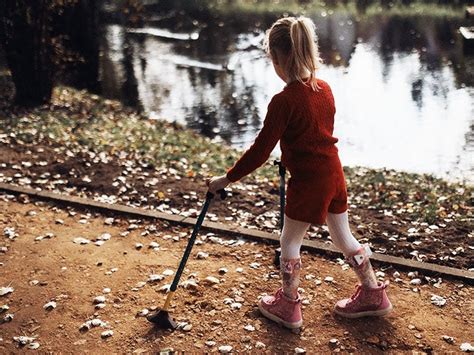 What Is Spastic Diplegia Cerebral Palsy