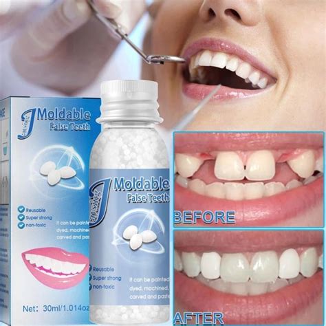 30ml Resin Temporary Tooth Repair Granules Teeth Gaps Missing Broken Tooth False Teeth Filling