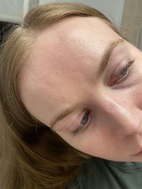 Confirmed Linear Scleroderma Line From Inner Left Eyebrow To Hairline