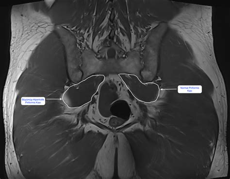 Piriformis Syndrome Symptoms Diagnosis And Treatment
