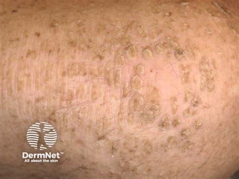 X Linked Ichthyosis Ichthyosiform Disorders Ppt Download