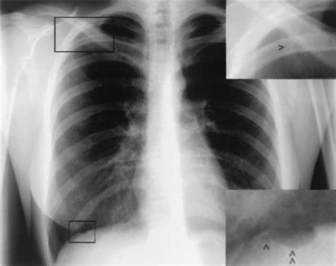 Chest Roentgenogram Showing Right Pneumothorax Associated With The