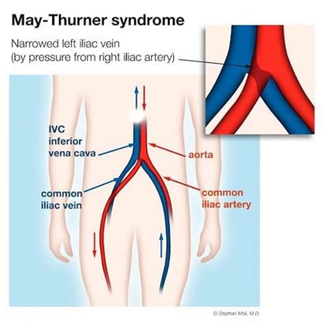 Understanding May Thurner Syndrome Mts Symptoms And Risks