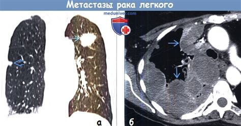 Метастазы рака легкого на рентгенограмме КТ МРТ ПЭТ