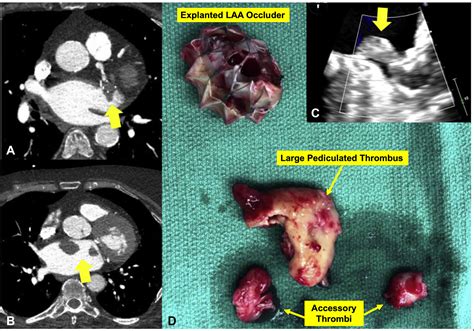 Device Related Thrombus After Left Atrial Appendage Occlusion Clinical