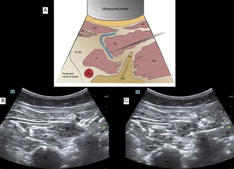 Quadratus Lumborum Block