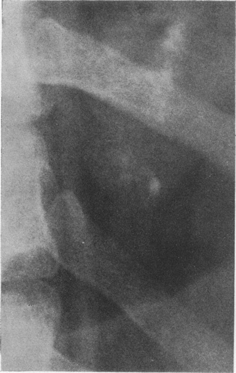 Plain Radiograph Of Left Adrenal Showing Punctate Calcification Download Scientific Diagram