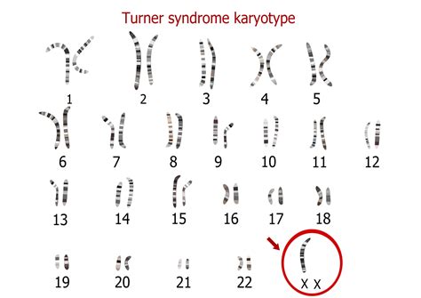 Turners Syndrome Drawing At Angelica Cox Blog