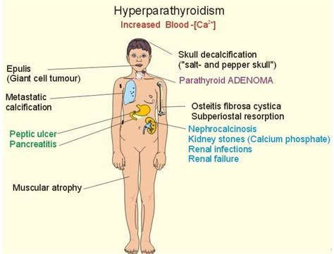 Hypoparathyroidism Artofit