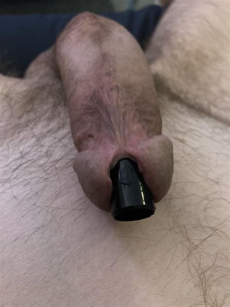 Sharpie Lid Stretching R MeatoSubincision