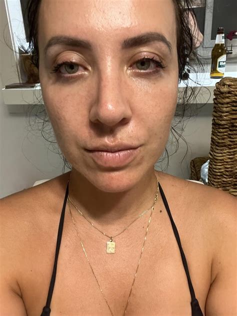 Nose Job 3 Weeks Post Very Uneven Swelling On Each Side And Still A