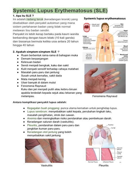 Systemic Lupus Erythematosus Sle Pdf
